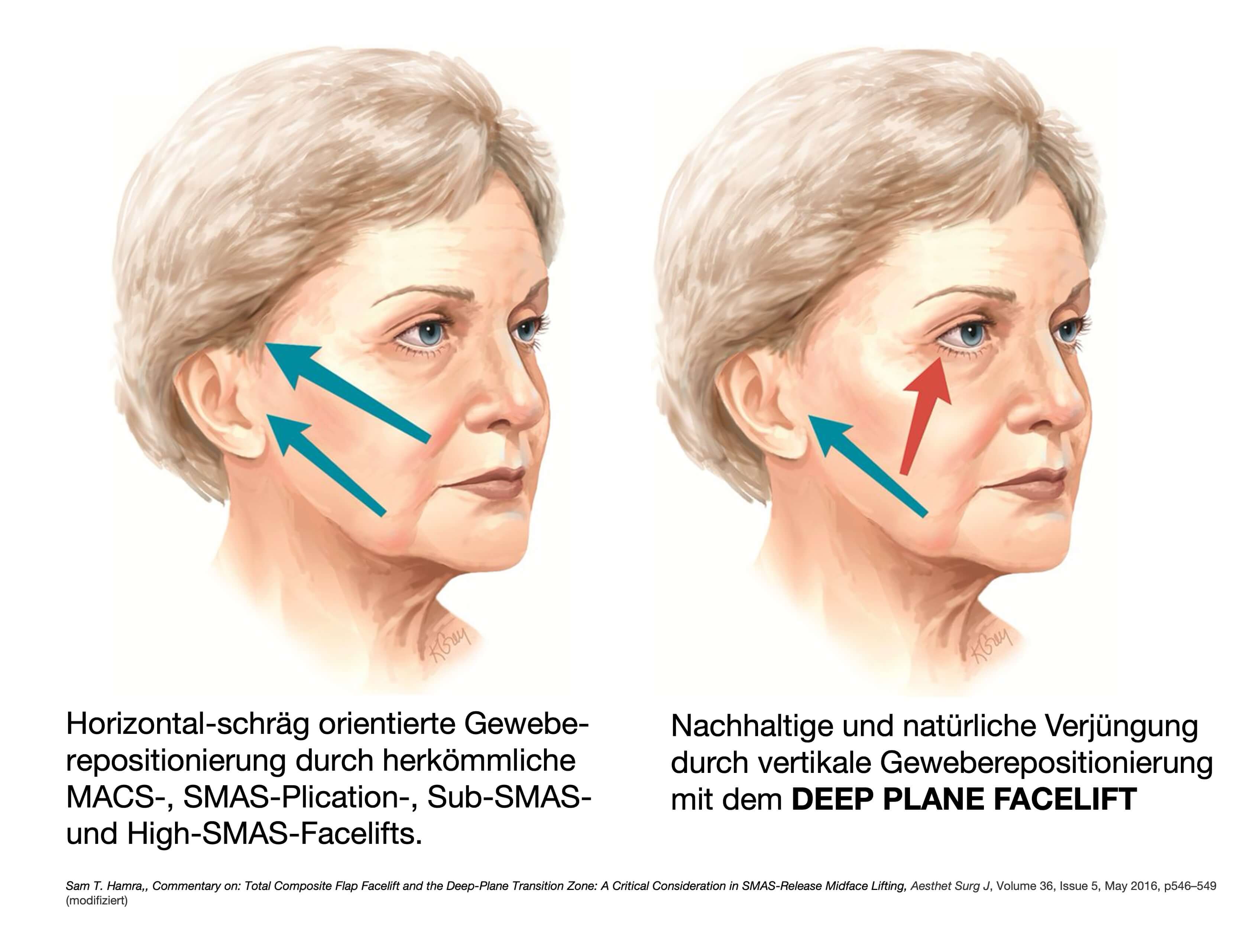 Deep Plane Facelift und Halsstraffung gegen Falten